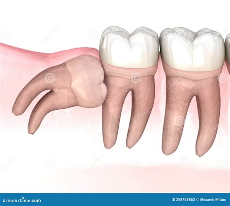 Horizontal Impaction Of Wisdom Tooth Medically Accurate Tooth 3D