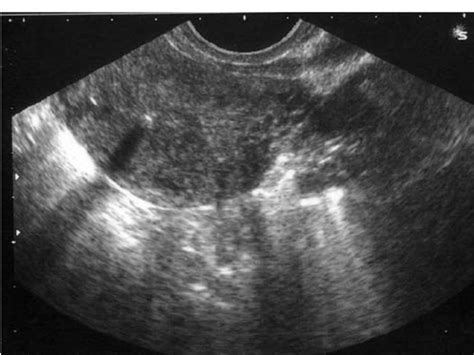 Ultrasound Appearance Of The Mirena Coil Download Scientific Diagram