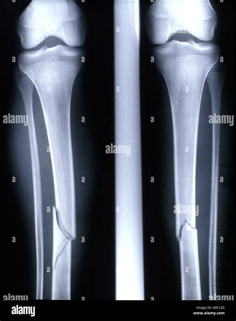 Fractured Tibia