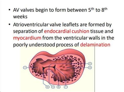 Atrioventricular Canal Defect Pptx Heart And Cardiovascular Diseases Diseases And Conditions