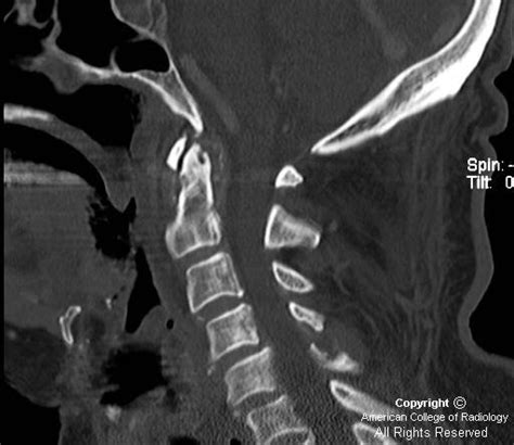 Neuroradiology On The Net Cppd Of The Cervical Spine Crown Dens