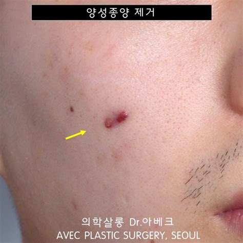 얼굴 피지낭종 핀홀법 사례 【dr 아베크 양성종양】 네이버 블로그
