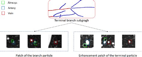 Figure 11 From Automatic Pulmonary Artery Vein Separation In Ct Images Using Twin Pipe Network