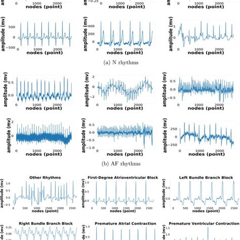 Sample Of Ecg Raw Data For A N B Af And C Non Af Rhythms From Download Scientific