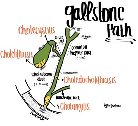 María Paula Forero Md On Twitter 🔸benign Gallstones Diseases🔸 🔺