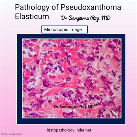 Pathology Of Pseudoxanthoma Elasticum Dermatopathology Pathology