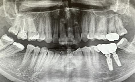Single Tooth Partial Denture Forget All The Options You Know