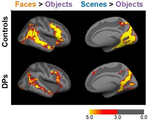 Inability To Recognize Faces Linked To Broader Visual Recognition Problems
