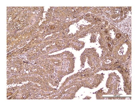 Conventional Ptc Positive Pn In Tumor Cells Diffuse Cytoplasmic