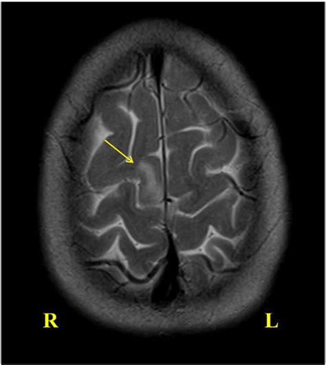 The Mri T2 Axial Sequence Obtained About 6 Months After The Symptom