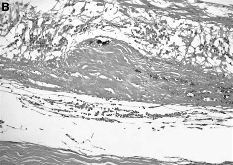Photomicrographs Show Choroidal Neovascularization Arising From The Download Scientific Diagram