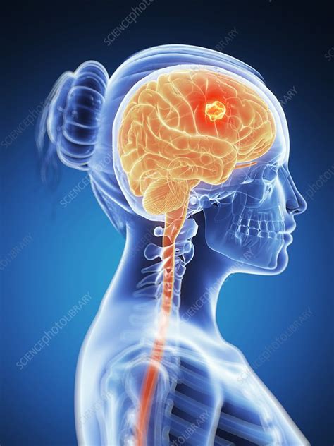 Tumour In The Brain Artwork Stock Image F Science Photo Library