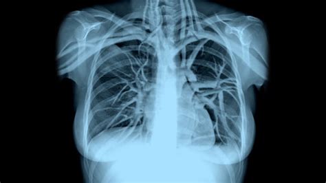 54 Chest X Ray Heart Stock Videos Footage And 4k Video Clips Getty Images