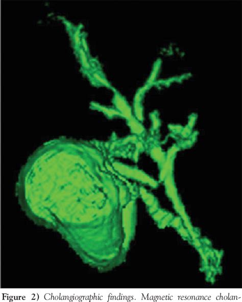 Figure 2 From Primary Sclerosing Cholangitis Semantic Scholar