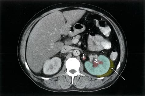 Radiology Rounds An Auntminnie Ct Of Pyelonephritis Renal Papillary And Calyceal Lesions At Ct