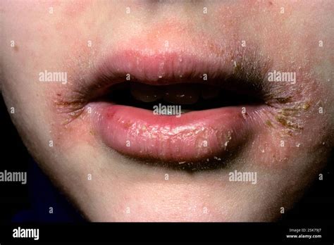 Close Up Of Skin Cracking And Splitting At The Sides Of The Mouth In A