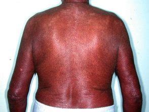 Imágenes de eritrodermia Hoogstra Centros Medicos