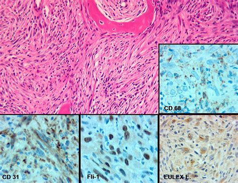 Pathology Outlines Intimal Sarcoma