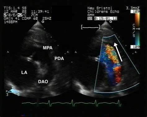 File Patent Ductus Arteriosus Echocardiogram  Embryology