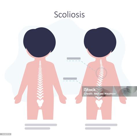 남학생과 함께하는 교육 포스터에는 척추측만증 문제가 있습니다 근골격계 장애가있는 어린이 강한 척추 측만증의 예 척추 곡률 개념 뒷모습 척추측만증에 대한 스톡 벡터 아트 및