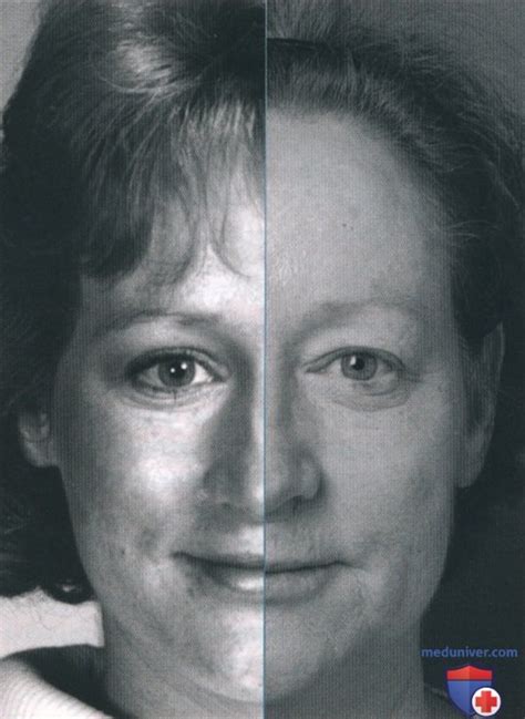 Коррекция красоты глаз с помощью ботулотоксина