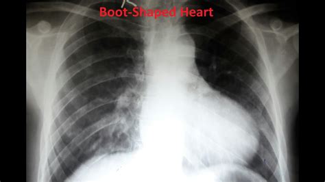 An Interesting Chest X Ray Tetralogy Of Fallot Tof Tof X Ray Boot Shaped Heart Youtube