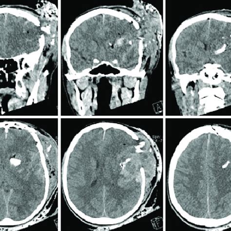 Preoperative CT Of The Head Demonstrating The Extent Of Scalp Download Scientific Diagram