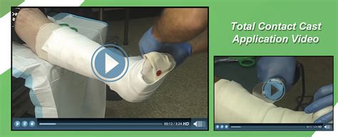 M Med Total Contact Cast Kits And Supplies