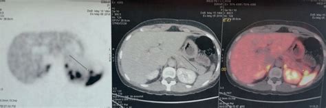 Figure 1 From Laparoscopic Distal Pancreatectomy With Spleen Preservation Semantic Scholar