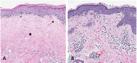 Frontiers Histopathological Differences Between Vitiligo And Lichen