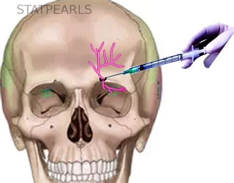 [figure Supraorbital Nerve Block] Statpearls Ncbi Bookshelf