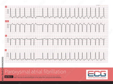 How Common Is Tachy Brady Syndrome At Donald Altman Blog