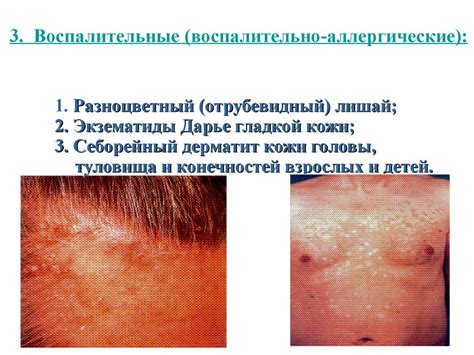 Грибковые заболевания кожи презентация онлайн