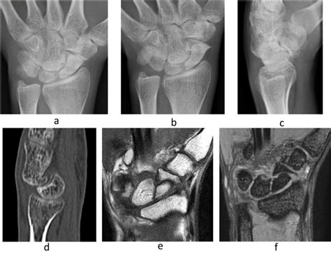 Initial X Rays In The Anteroposterior View A Ulnar Deviation View Download Scientific