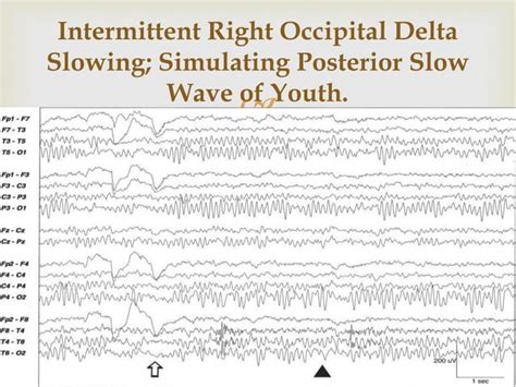 Posterior Slow Waves Of Youth Pptx