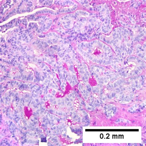 Cholangiocarcinoma Libre Pathology