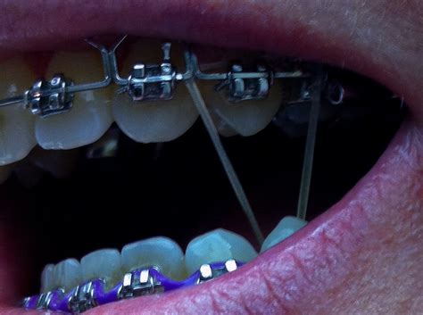 What Do Rubber Bands Do On Braces OC Dental Center