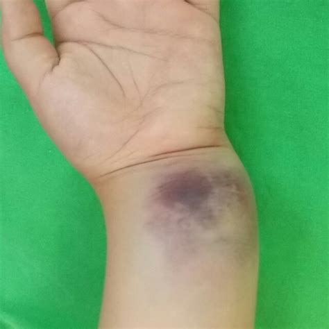 The Appearance Of The Left Wrist On Presentation To The Emergency