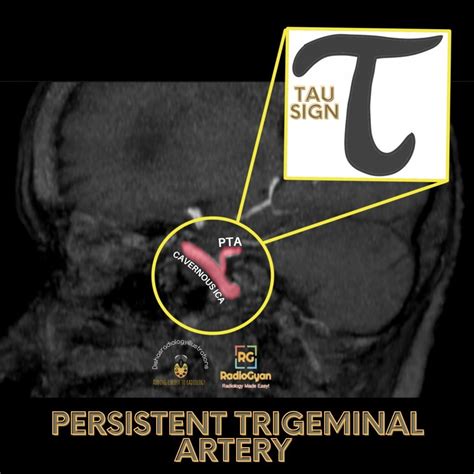 Persistent Trigeminal Artery Radiology Case