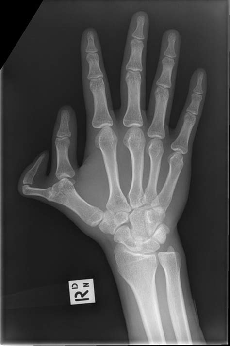 Pre Axial Polydactyly Refers To Polydactyly Where The Additional Digit