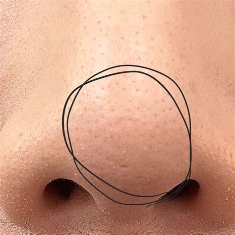 의사에게 물어보세요 코 수술 후 피부 강남언니 1등 성형수술and피부시술 정보앱