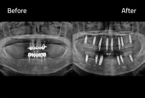 무치악 전체 임플란트 치료 전·후 서울스마트치과의원