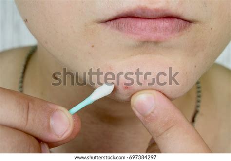 Mens Pimple Treatment Before After Image Foto De Stock 697384297 Shutterstock