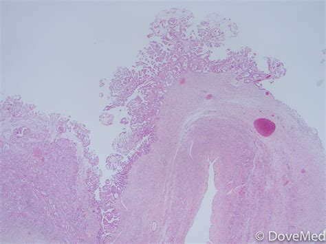 Clear Cell Adenocarcinoma Of Ovary