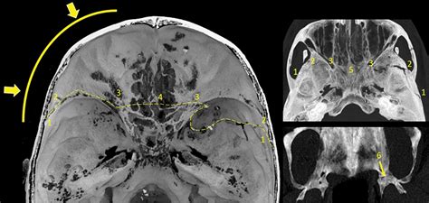 Ct Of Skull Base Fractures Classification Systems Complications And