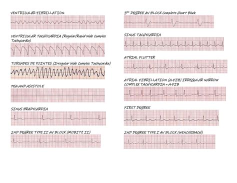Cardiac Rhythm Examples Etsy Cardiac Rhythm Examples Etsy