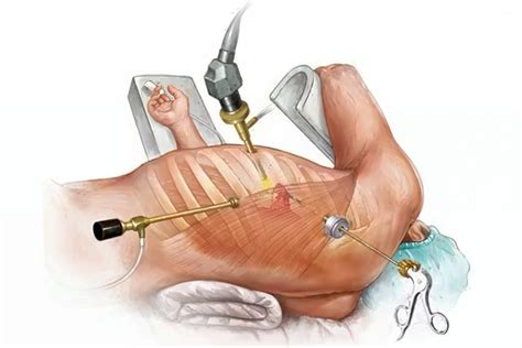 Lung Cancer Wedge Resection For Early Stage Lung Conditions