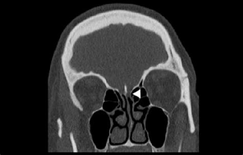 Cribriform Plate Mri