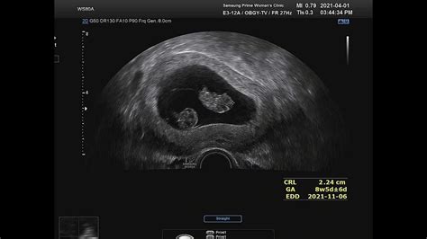 일란성 쌍둥이 초음파 Youtube