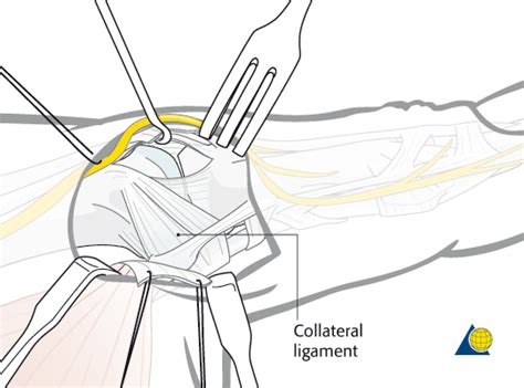 Thumb Approach Dorsoulnar To MCP Joint Of Thumb AO Surgery Reference Orthopedics Thumb